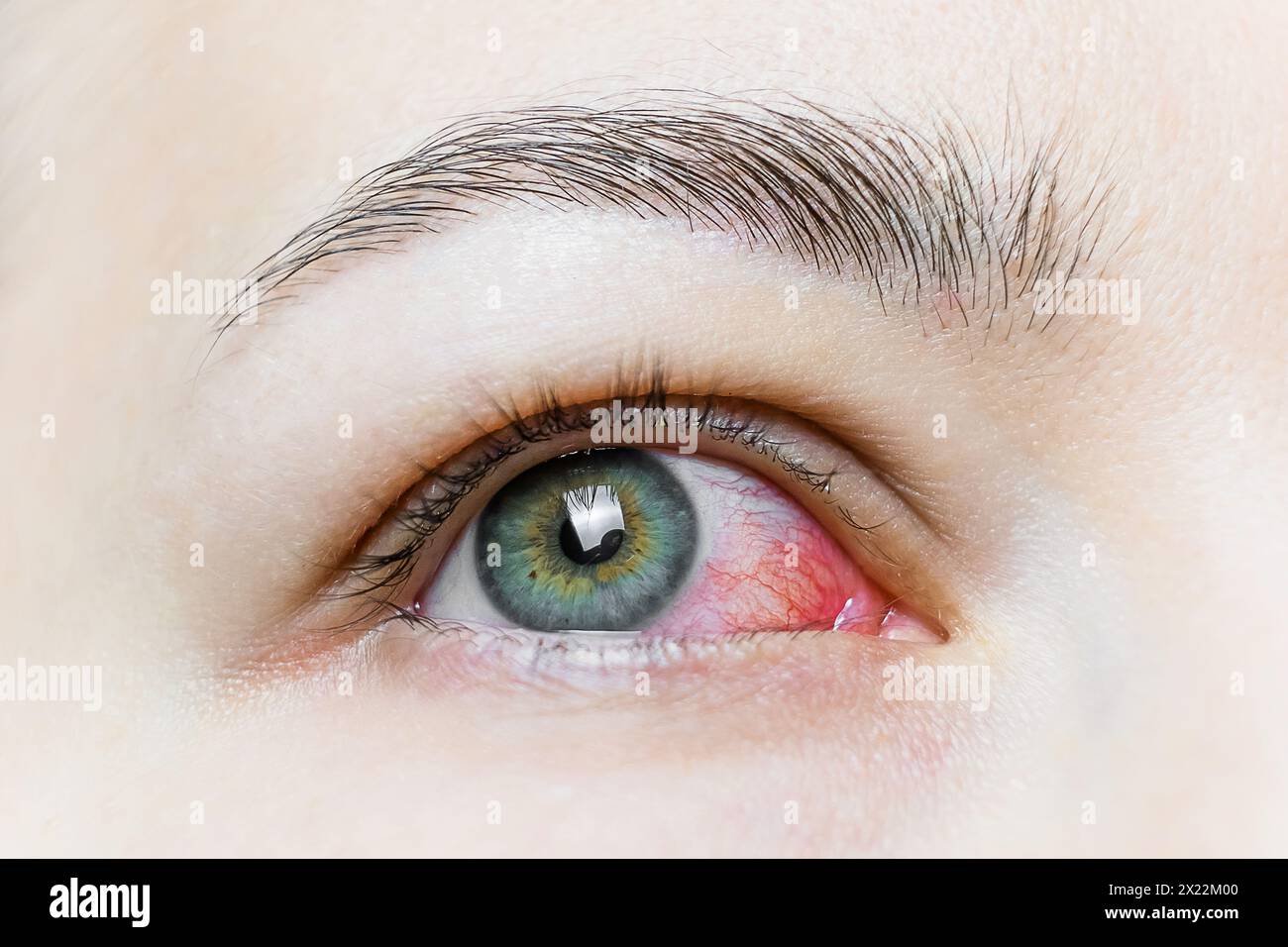 Close up of a severe bloodshot red eye. Viral Blepharitis ...