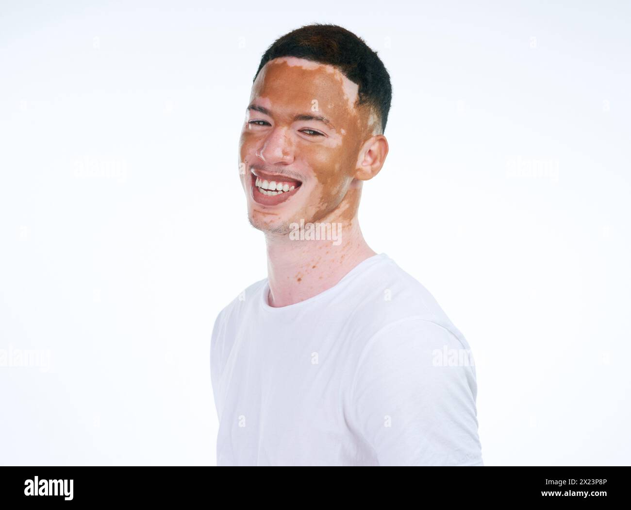 Happy, handsome and portrait of man with vitiligo or skin pigmentation ...
