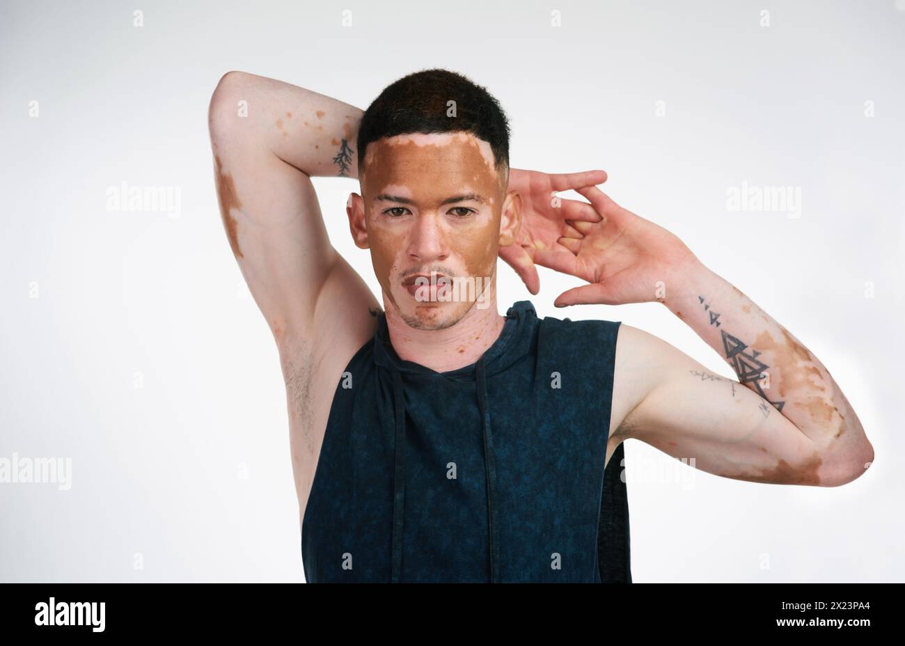 Vitiligo male model hi-res stock photography and images - Alamy