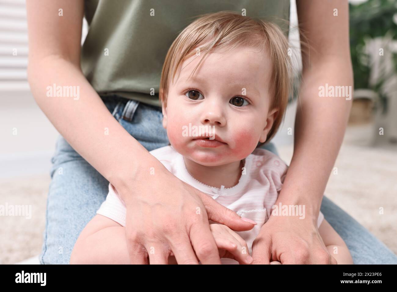 Mother and daughter with diathesis symptom on cheeks indoors, closeup ...