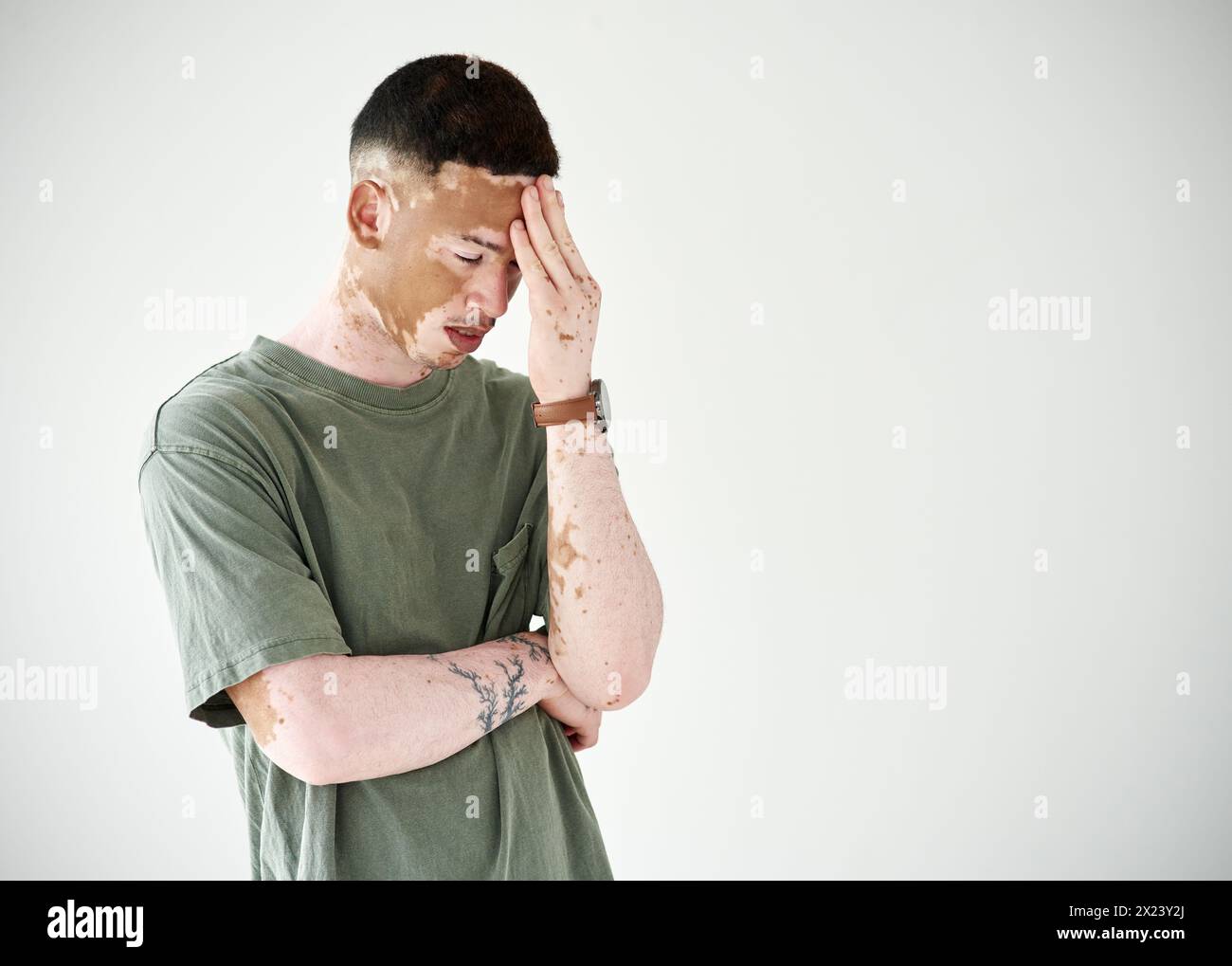 Sad, anxiety and man in depression with headache and worry for vitiligo ...