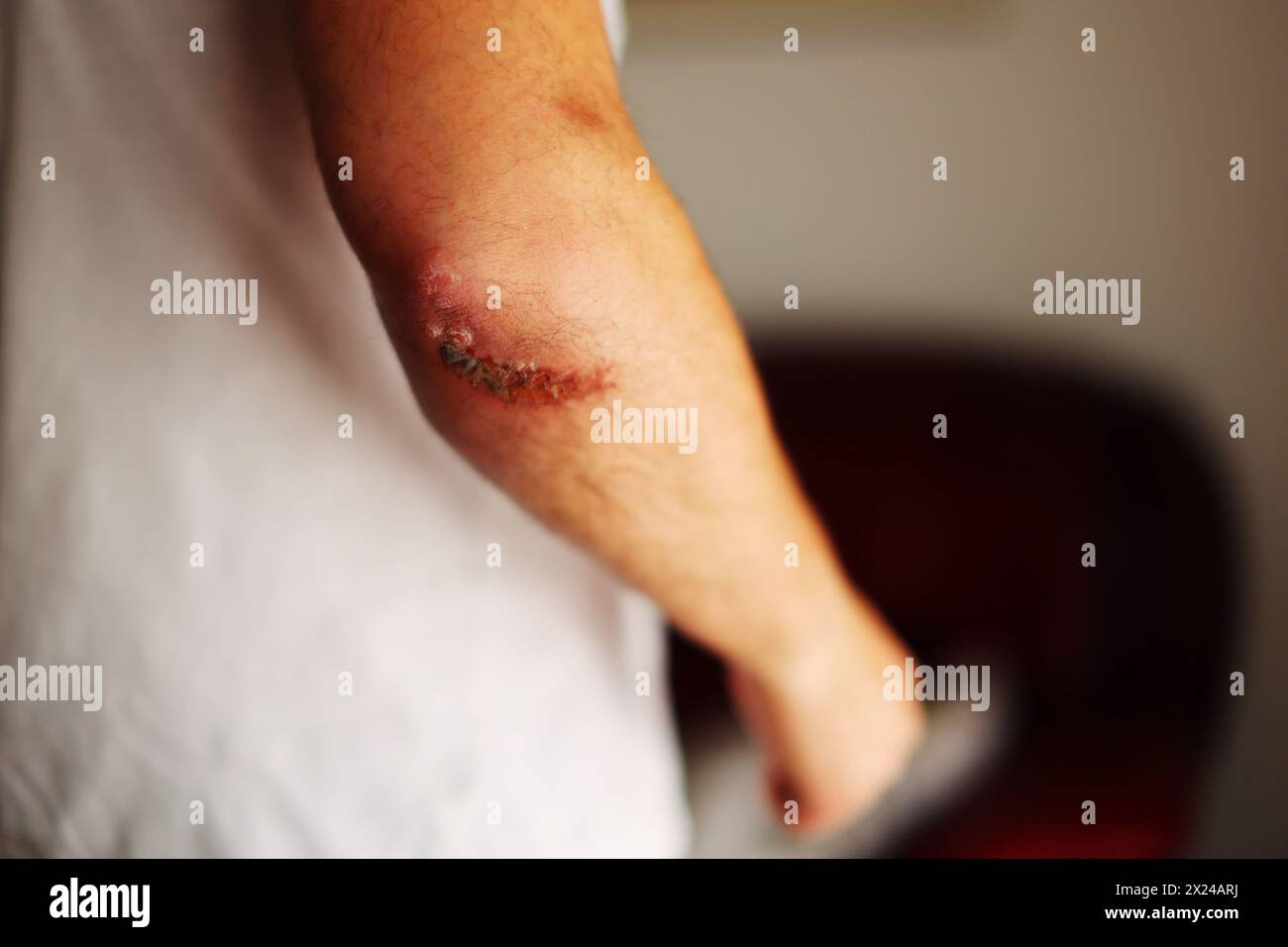 Burn victim skin scar hi-res stock photography and images - Alamy