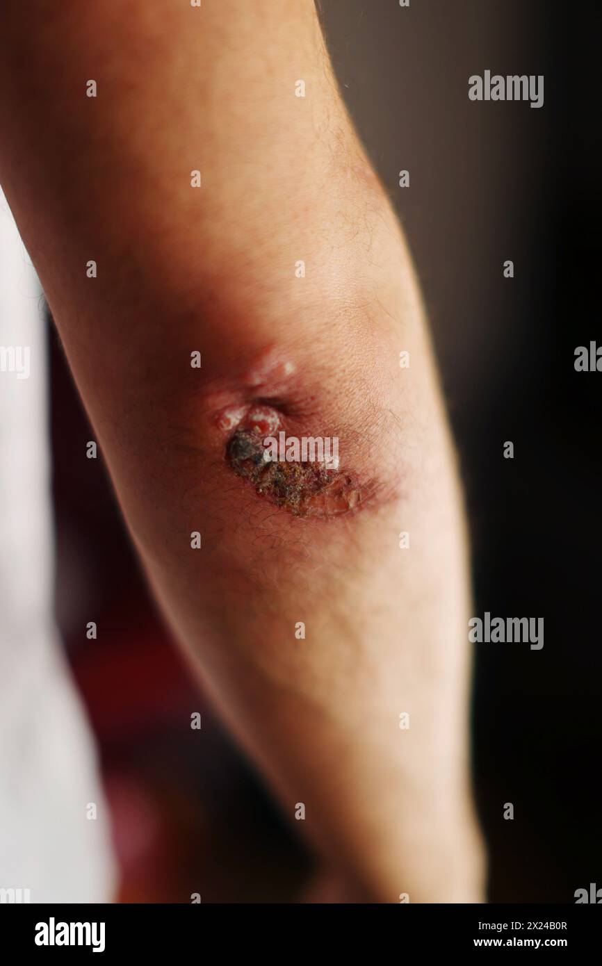 Skin abrasion hi-res stock photography and images - Alamy