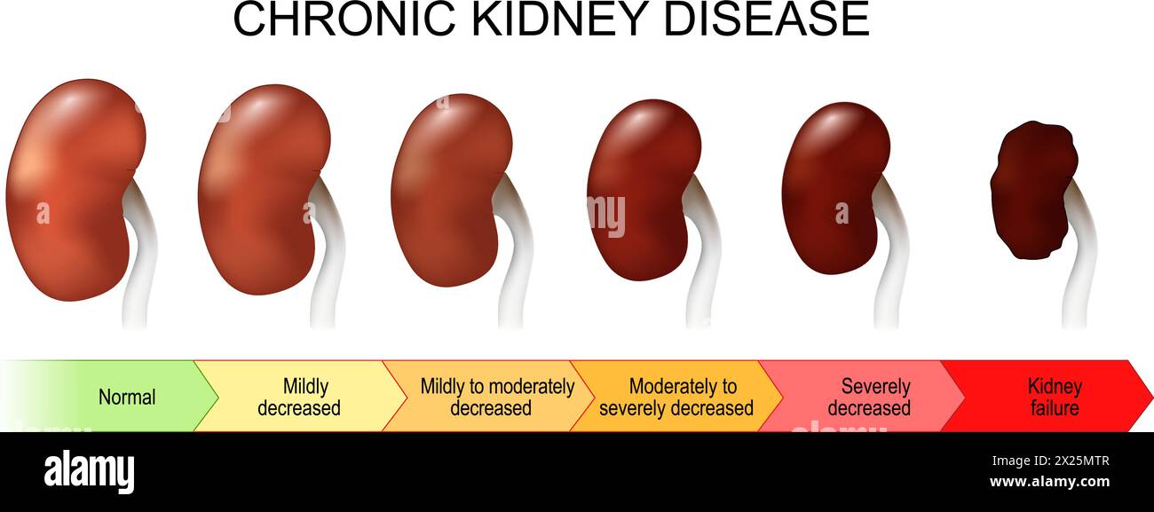Chronic kidney disease. Stage of disease from Normal and Mildly ...