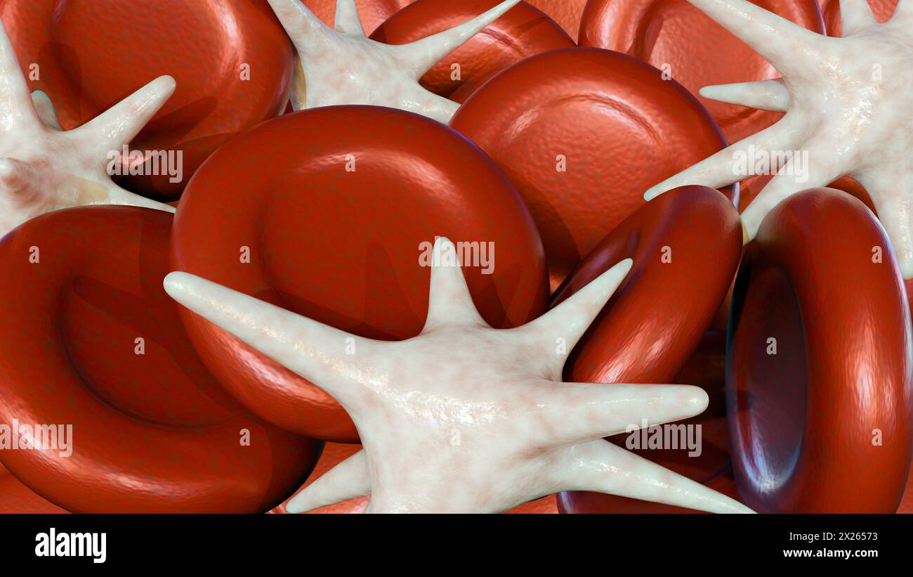 A 3D rendering of blood clot that travels to another part of the body ...