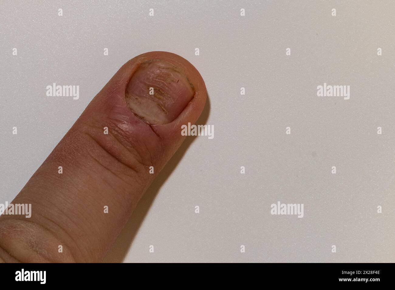 fungal nail infection Onychomycosis. dry coarse skin of the legs Stock ...