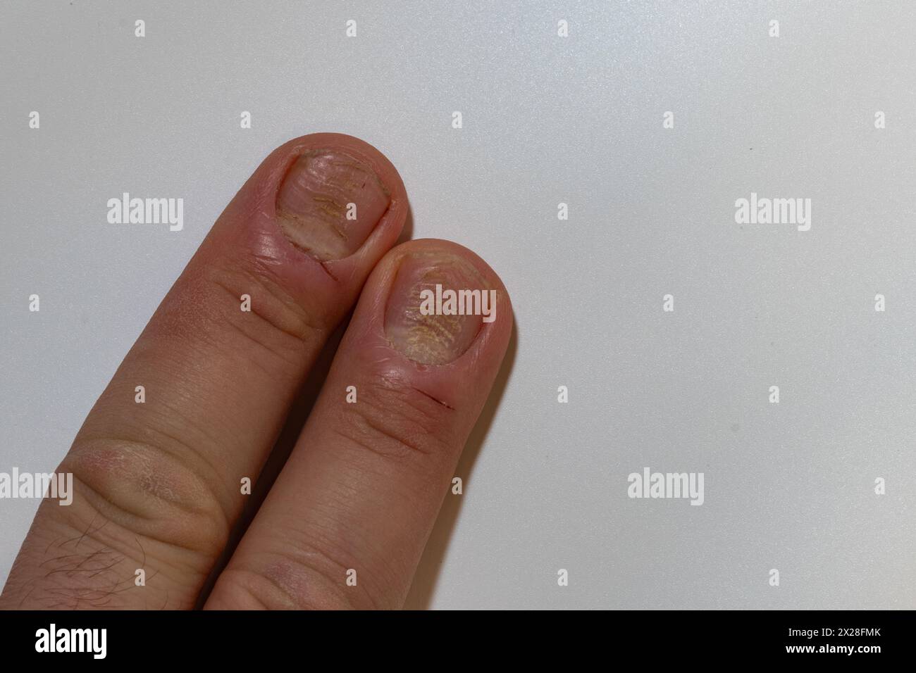 fungal nail infection Onychomycosis. dry coarse skin of the legs Stock ...