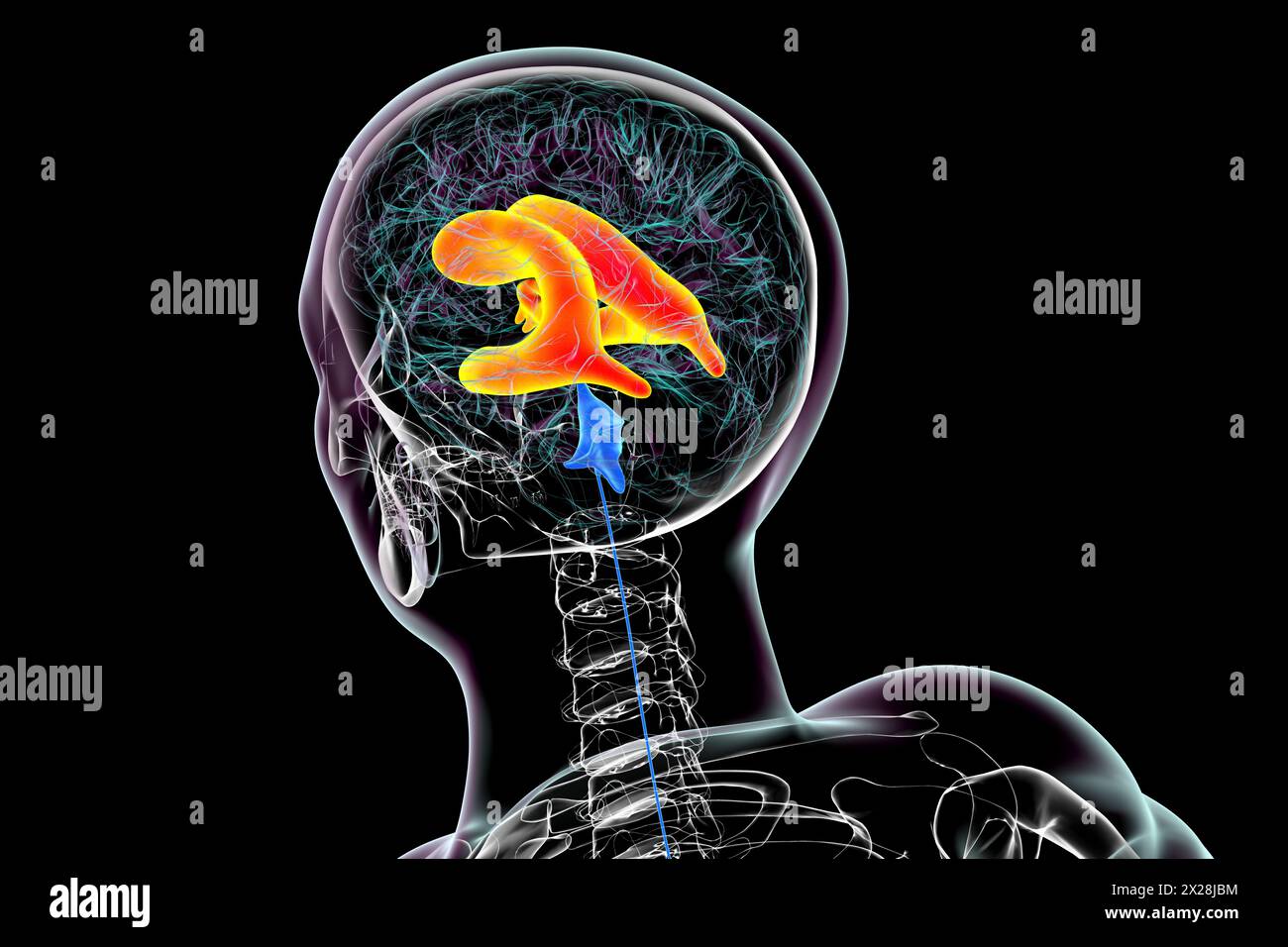 Enlarged lateral and third brain ventricles, illustration Stock Photo ...