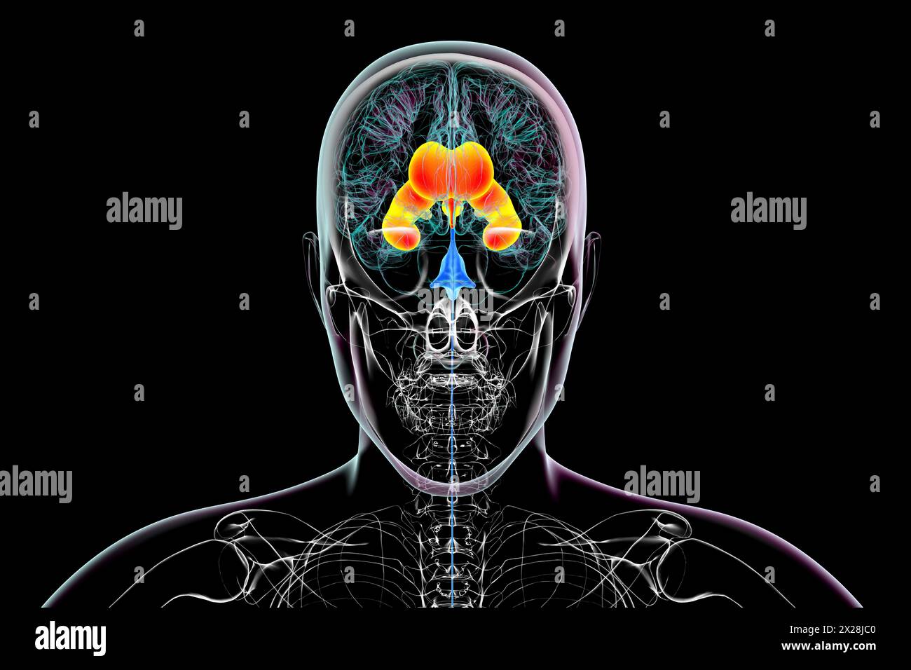 Enlarged lateral and third brain ventricles, illustration Stock Photo ...