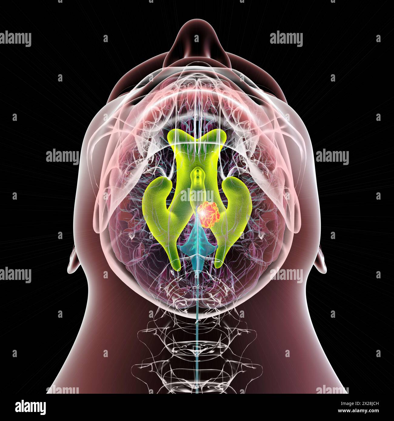 Hydrocephalus hi-res stock photography and images - Alamy