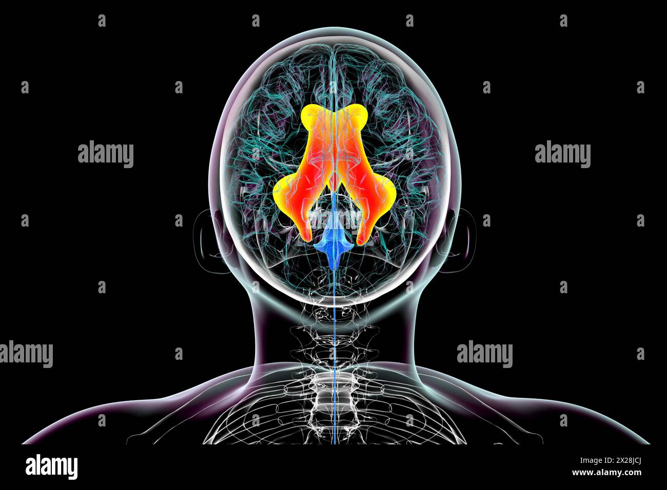 Enlarged lateral and third brain ventricles, illustration Stock Photo ...