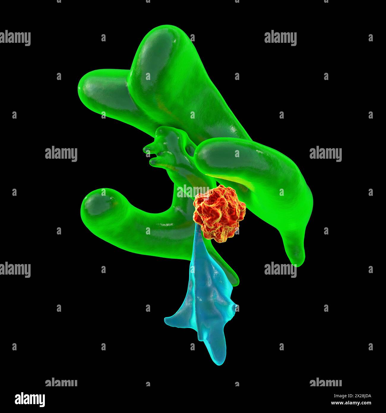 Brain tumour causing hydrocephalus, illustration Stock Photo - Alamy