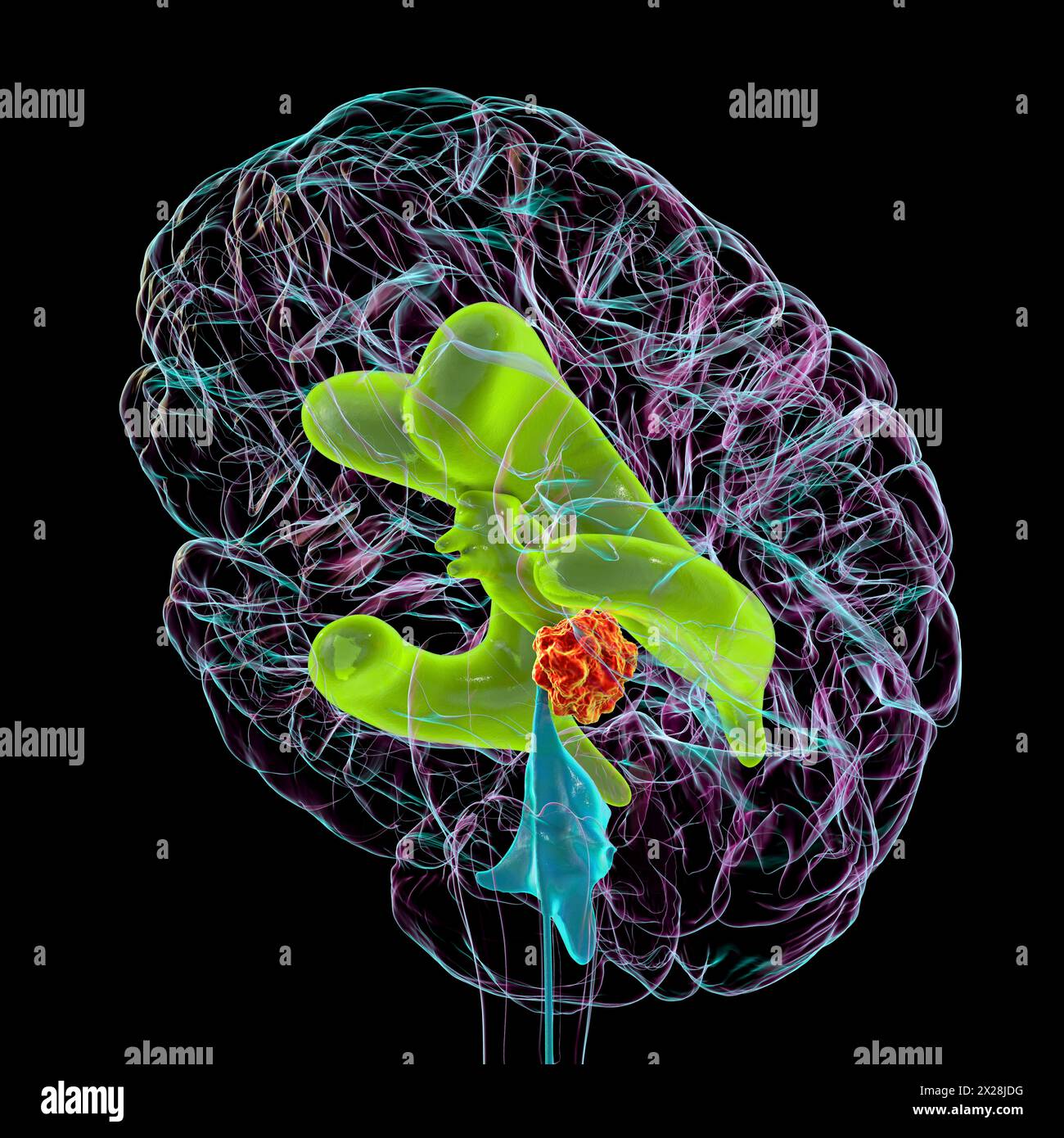 Hydrocephalus hi-res stock photography and images - Alamy