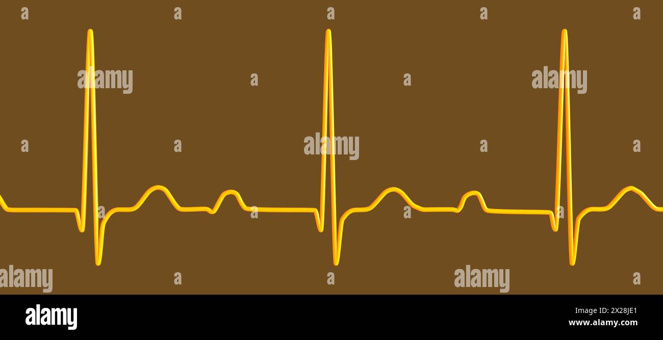 ECG displaying first degree AV block, illustration Stock Photo - Alamy