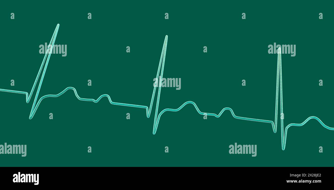 ECG displaying first degree AV block, illustration Stock Photo - Alamy ECG displaying first degree AV block, illustration Stock Photo - Alamy