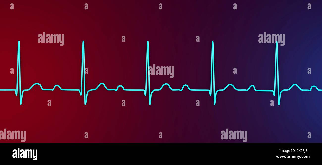 ECG displaying first degree AV block, illustration Stock Photo - Alamy
