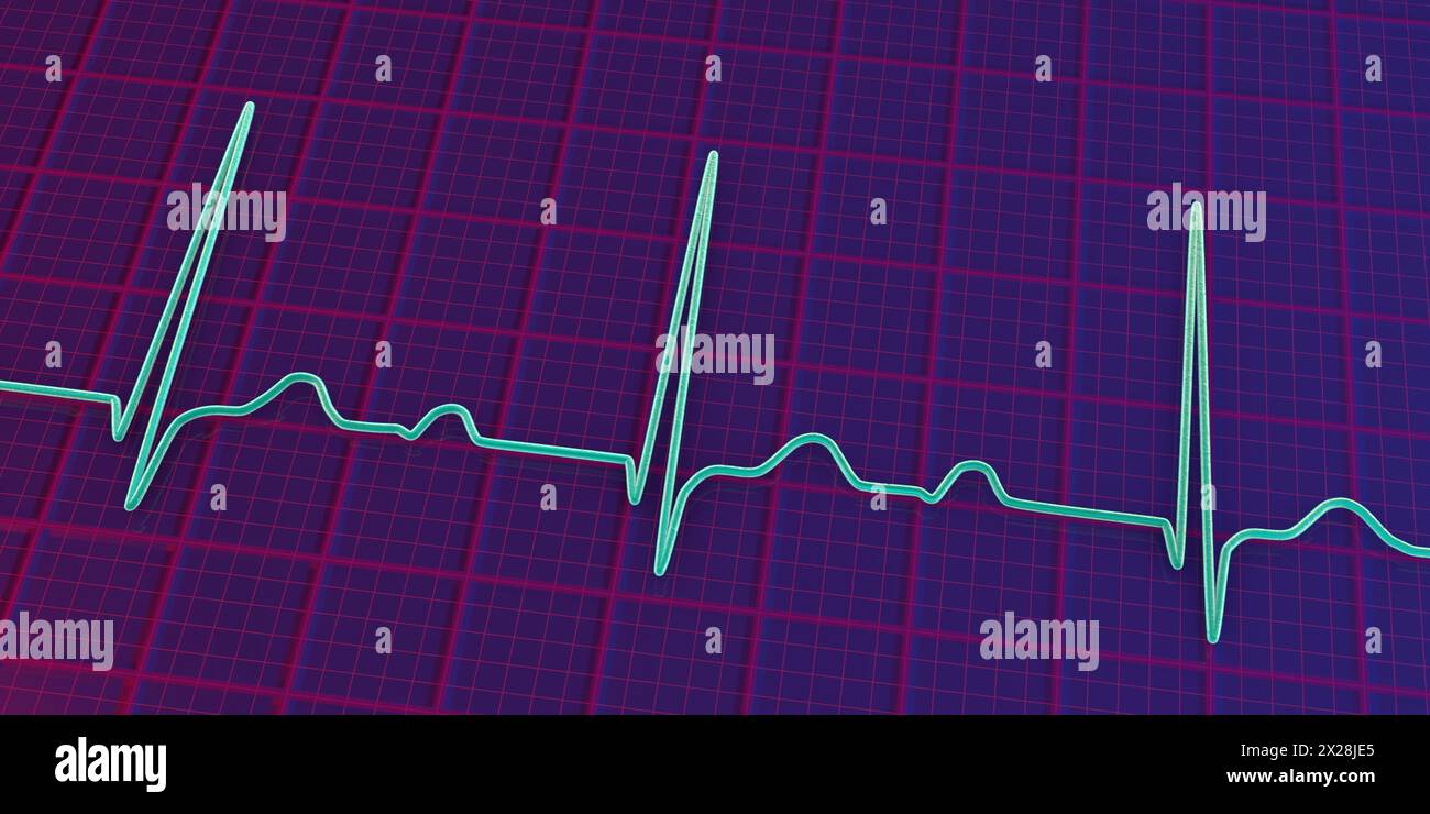 ECG displaying first degree AV block, illustration Stock Photo - Alamy
