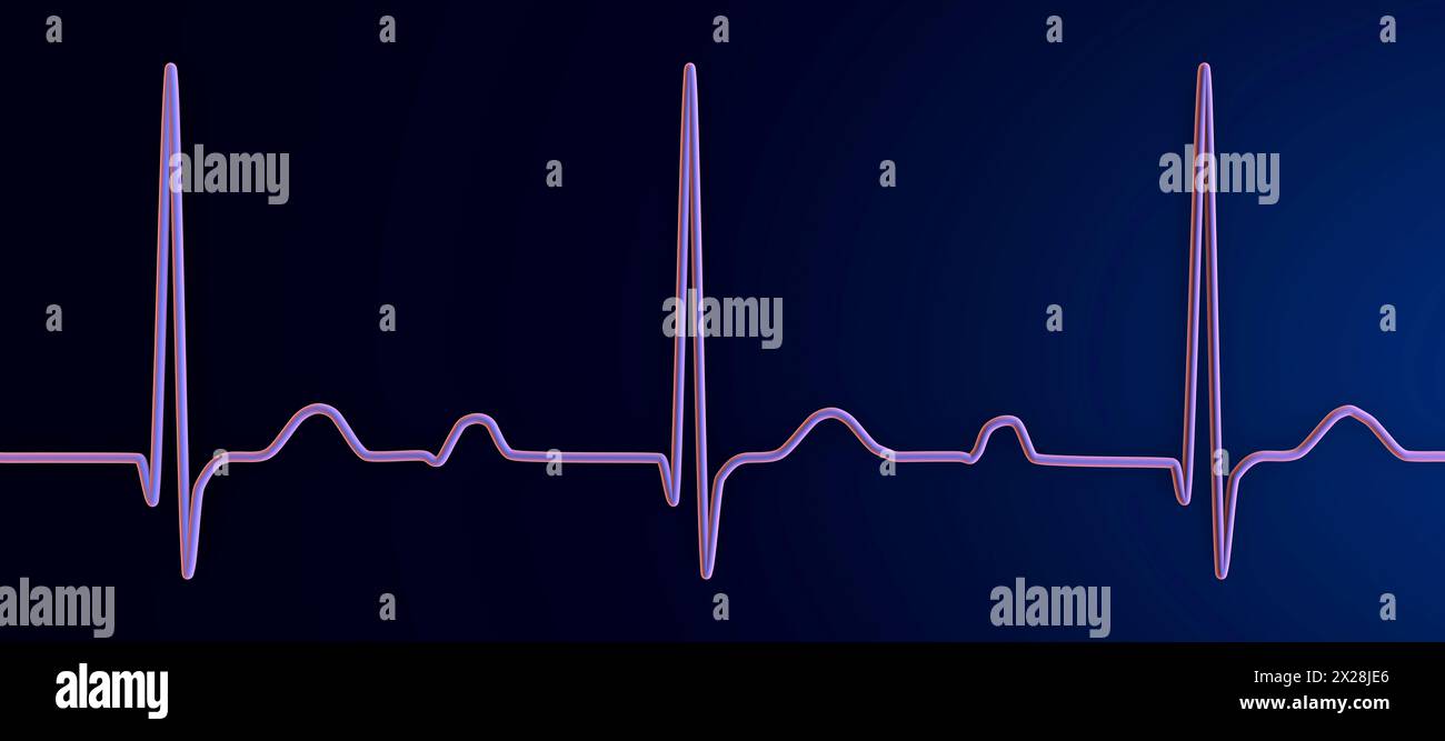 ECG displaying first degree AV block, illustration Stock Photo - Alamy