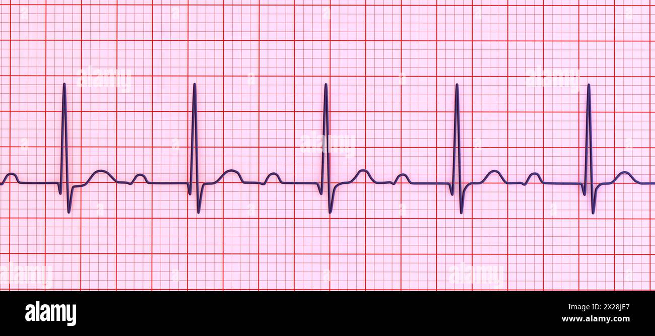 ECG displaying first degree AV block, illustration Stock Photo - Alamy ECG displaying first degree AV block, illustration Stock Photo - Alamy