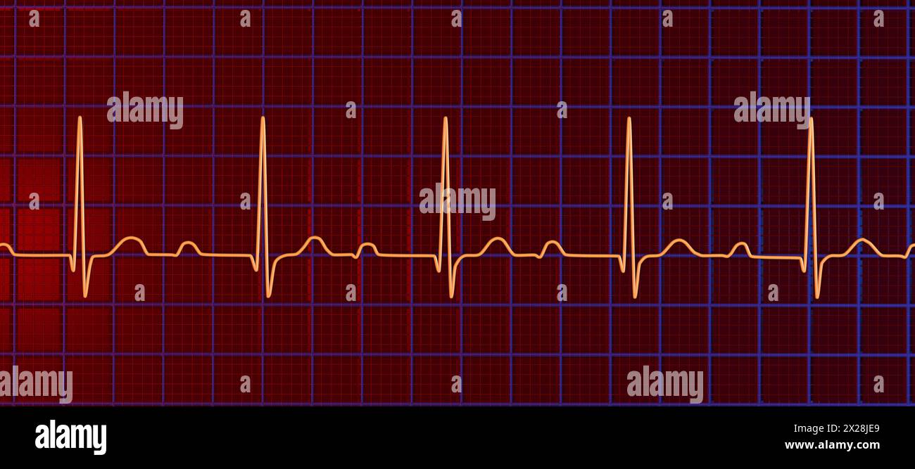 ECG displaying first degree AV block, illustration Stock Photo - Alamy