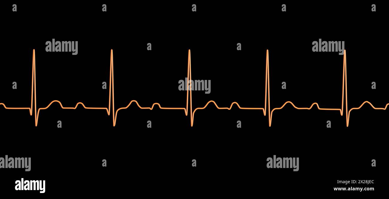 ECG displaying first degree AV block, illustration Stock Photo - Alamy