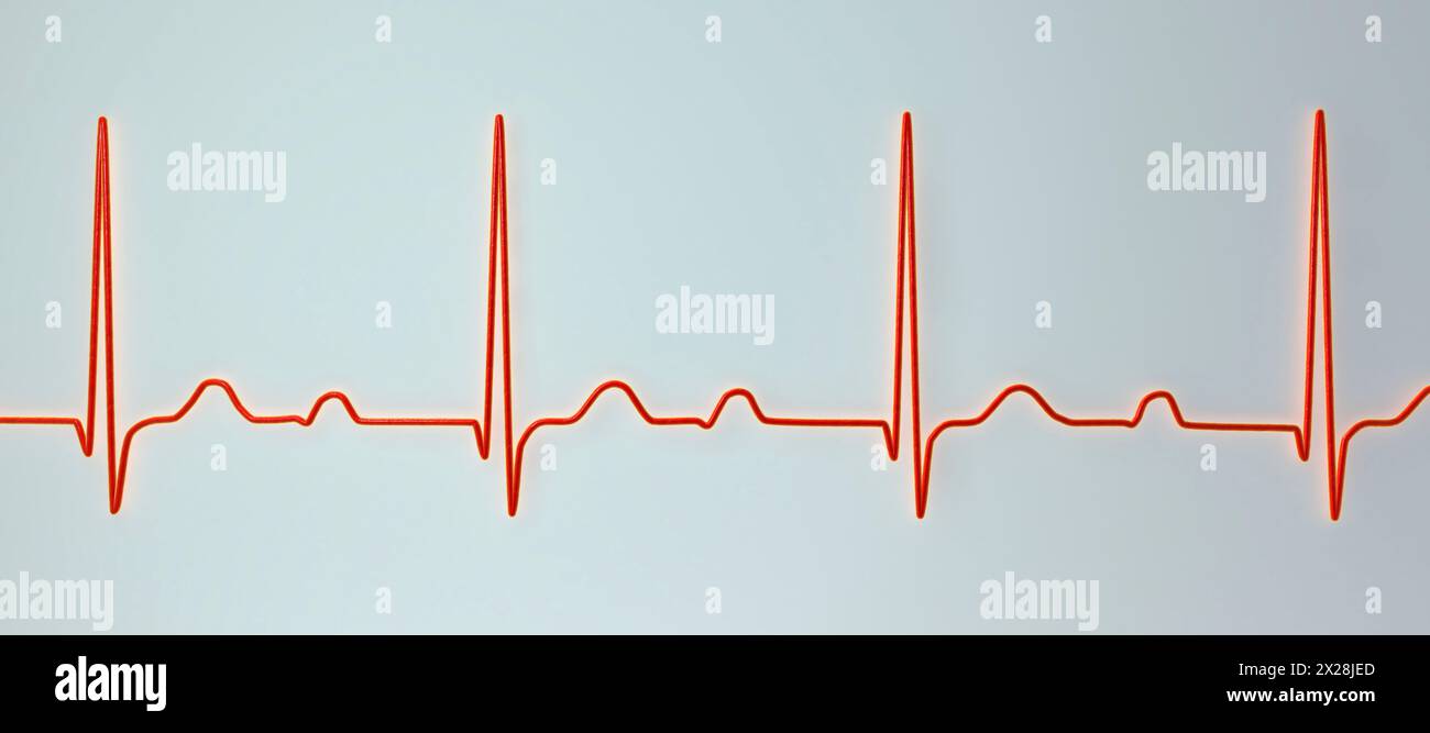 ECG displaying first degree AV block, illustration Stock Photo - Alamy ECG displaying first degree AV block, illustration Stock Photo - Alamy