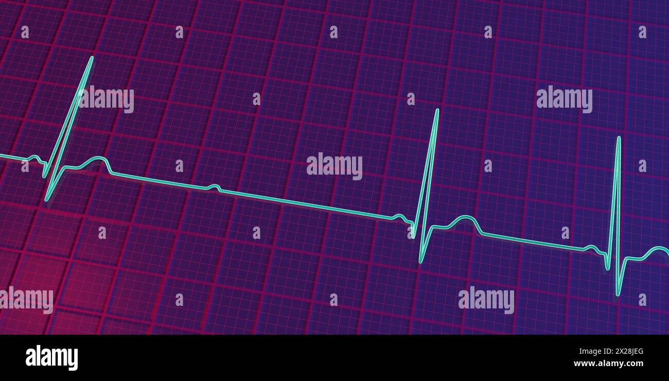 ECG with second degree Mobitz 2 AV block, illustration Stock Photo - Alamy