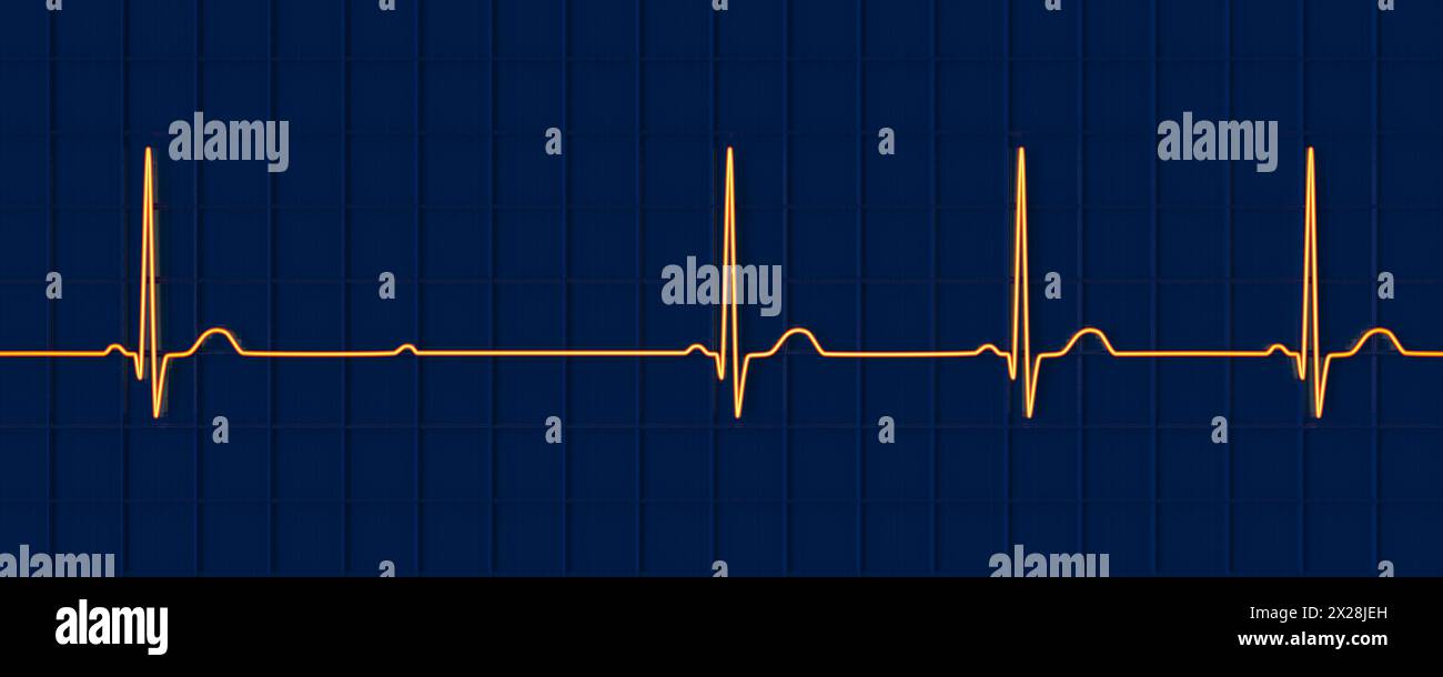 ECG with second degree Mobitz 2 AV block, illustration Stock Photo - Alamy