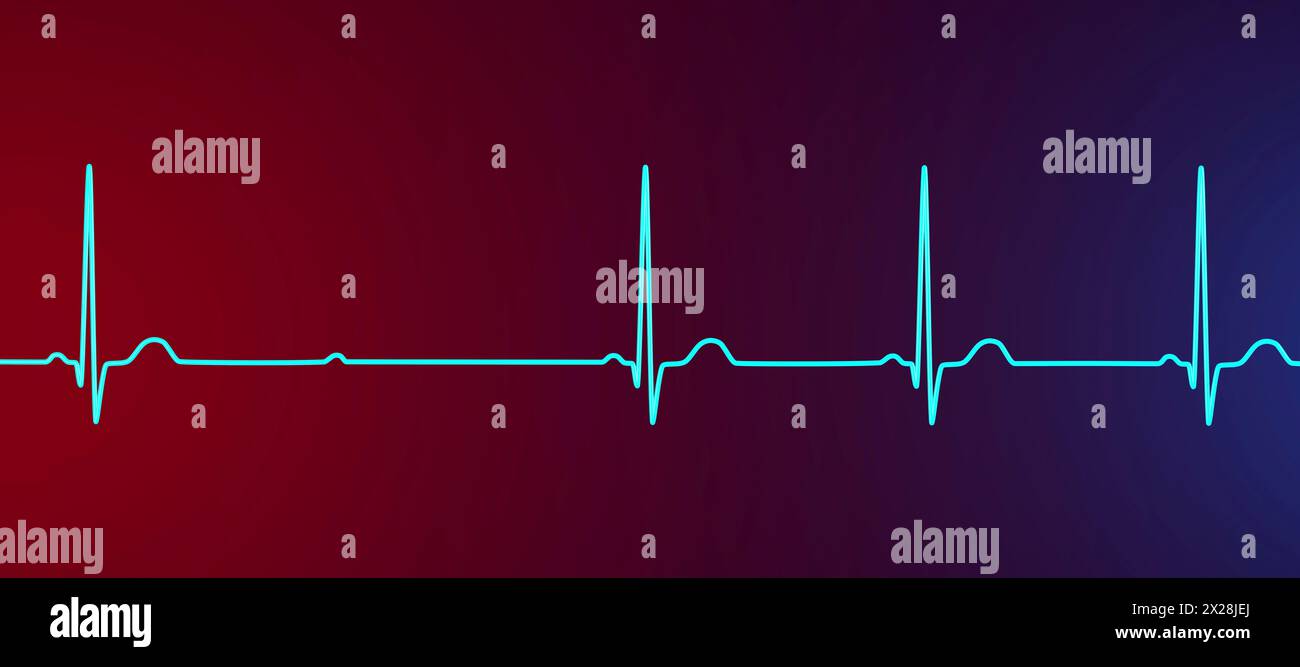 ECG with second degree Mobitz 2 AV block, illustration Stock Photo - Alamy