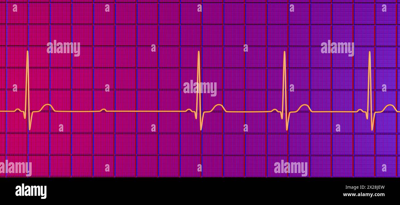 ECG with second degree Mobitz 2 AV block, illustration Stock Photo - Alamy ECG with second degree Mobitz 2 AV block, illustration Stock Photo - Alamy