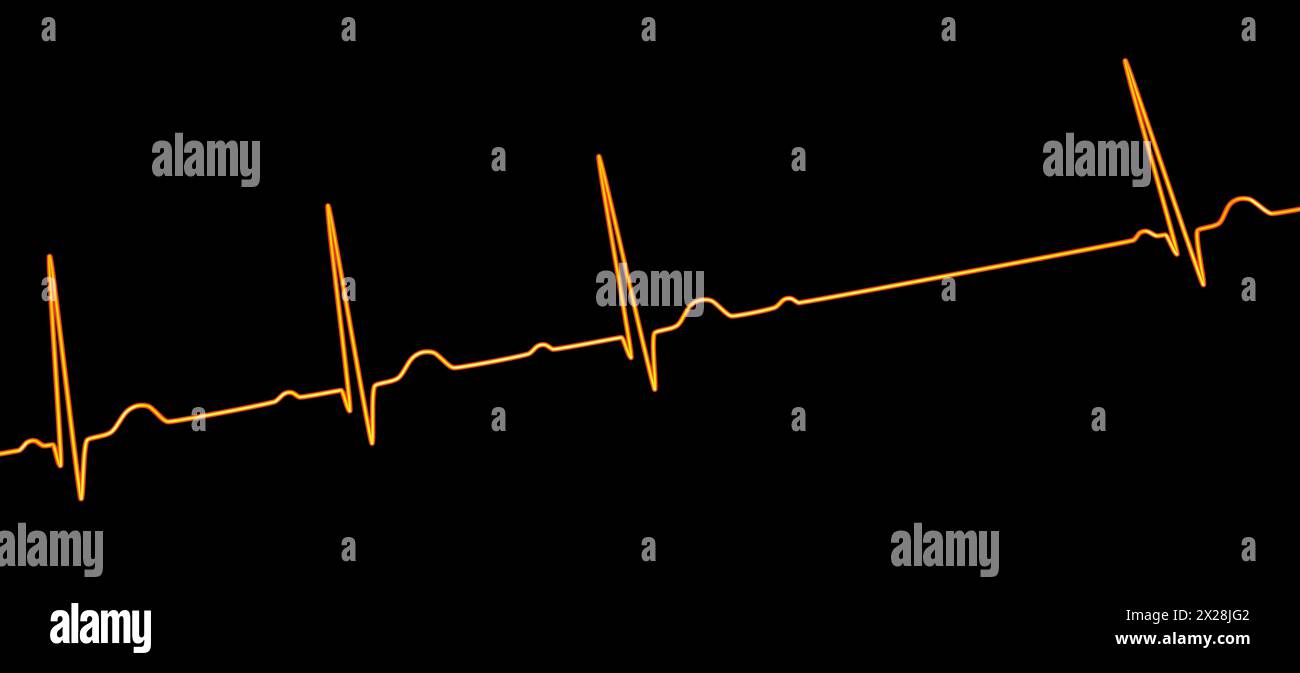 ECG with second degree AV block, illustration Stock Photo - Alamy ECG with second degree AV block, illustration Stock Photo - Alamy
