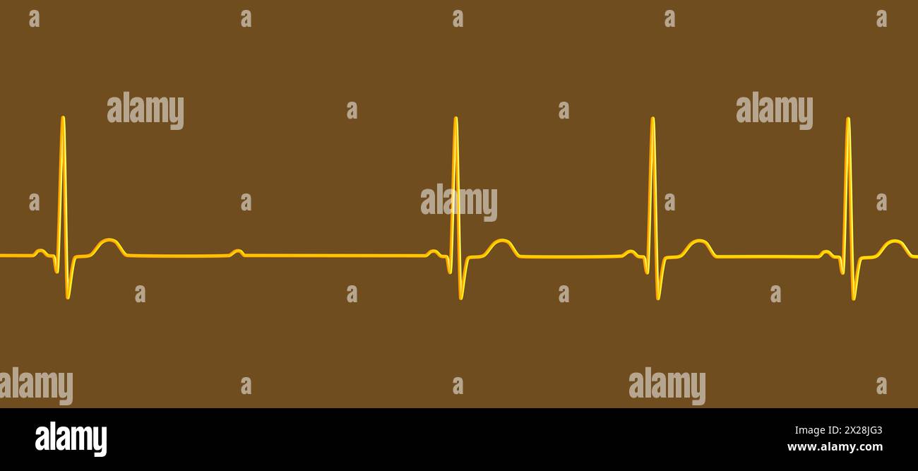 ECG with second degree Mobitz 2 AV block, illustration Stock Photo - Alamy