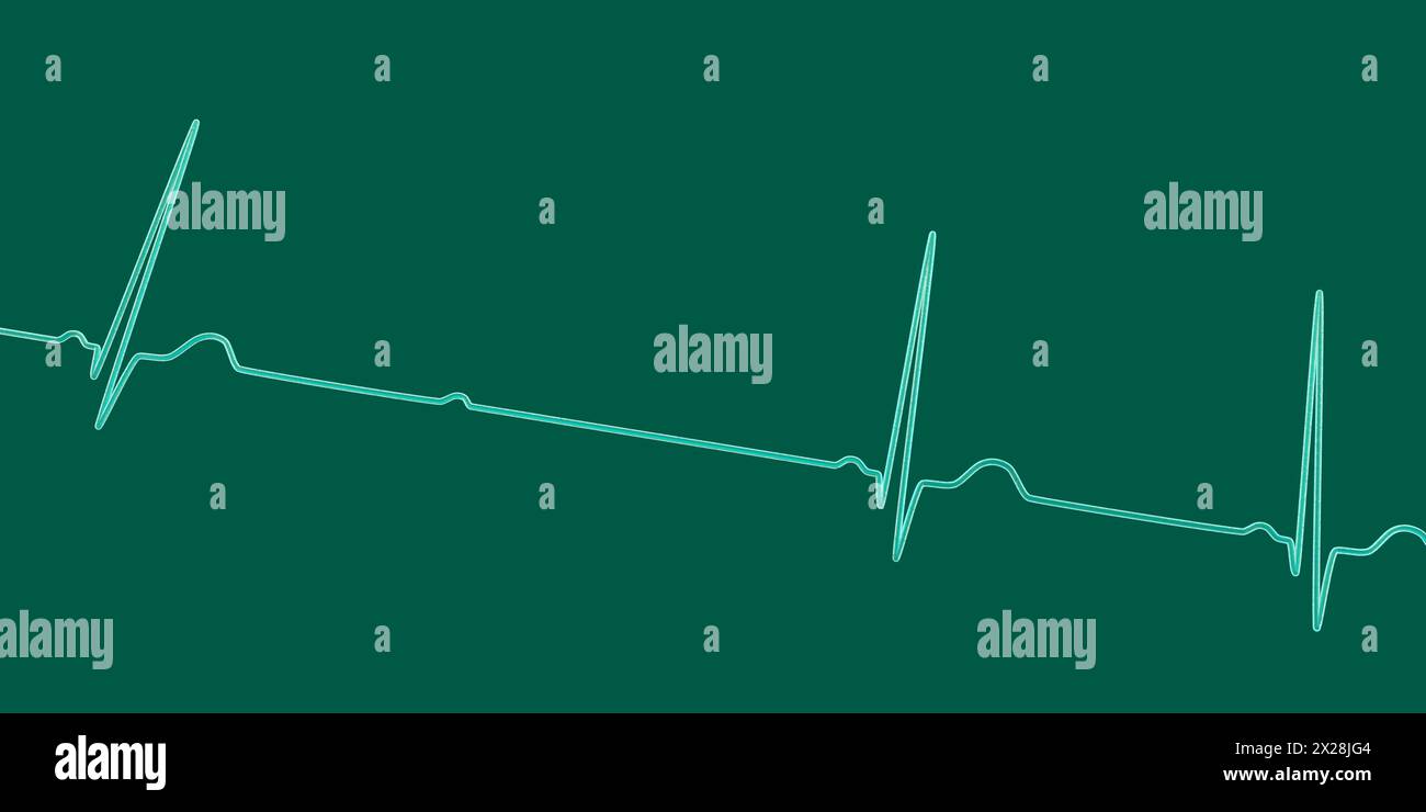ECG with second degree Mobitz 2 AV block, illustration Stock Photo - Alamy