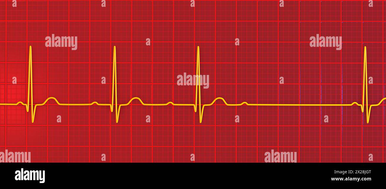 ECG with second degree AV block, illustration Stock Photo - Alamy