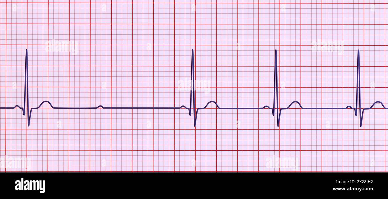 ECG with second degree Mobitz 2 AV block, illustration Stock Photo - Alamy