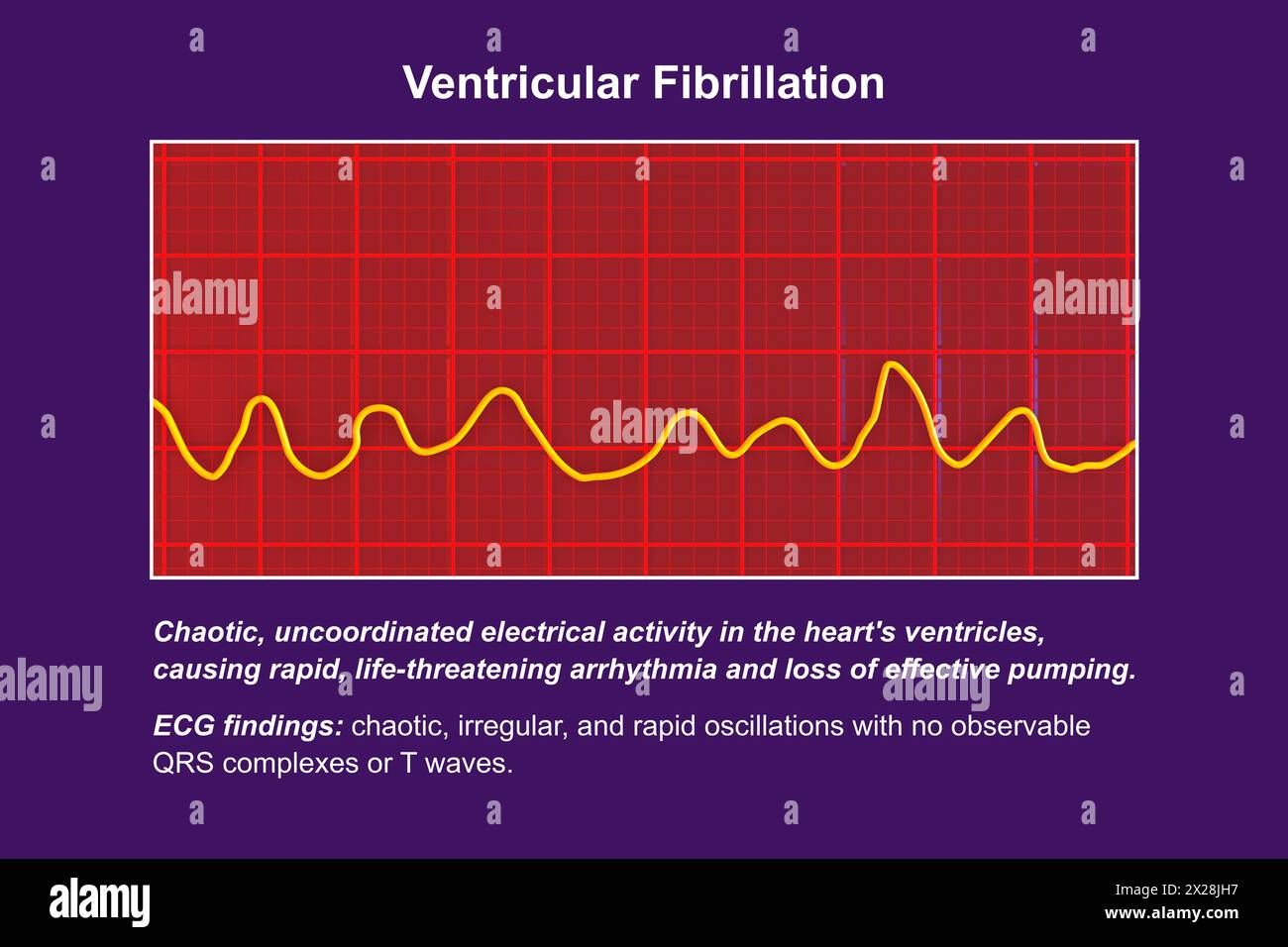 Ventricular fibrillation hi-res stock photography and images - Alamy
