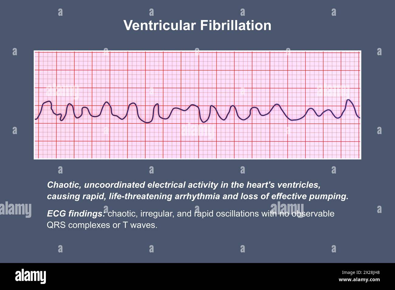 Ventricular fibrillation hi-res stock photography and images - Alamy