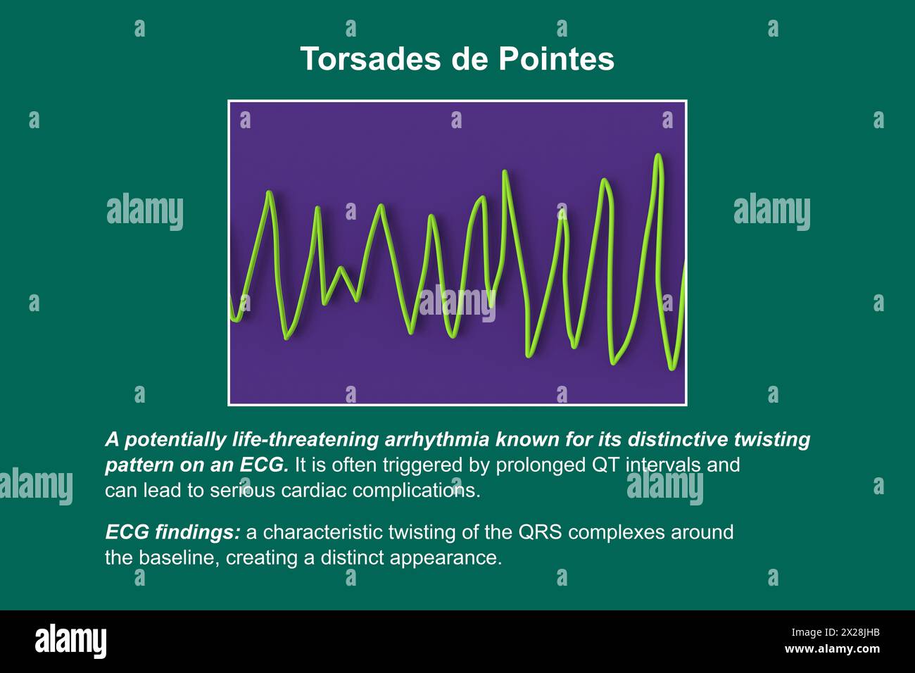 ECG displaying Torsades de pointes rhythm, illustration Stock Photo - Alamy