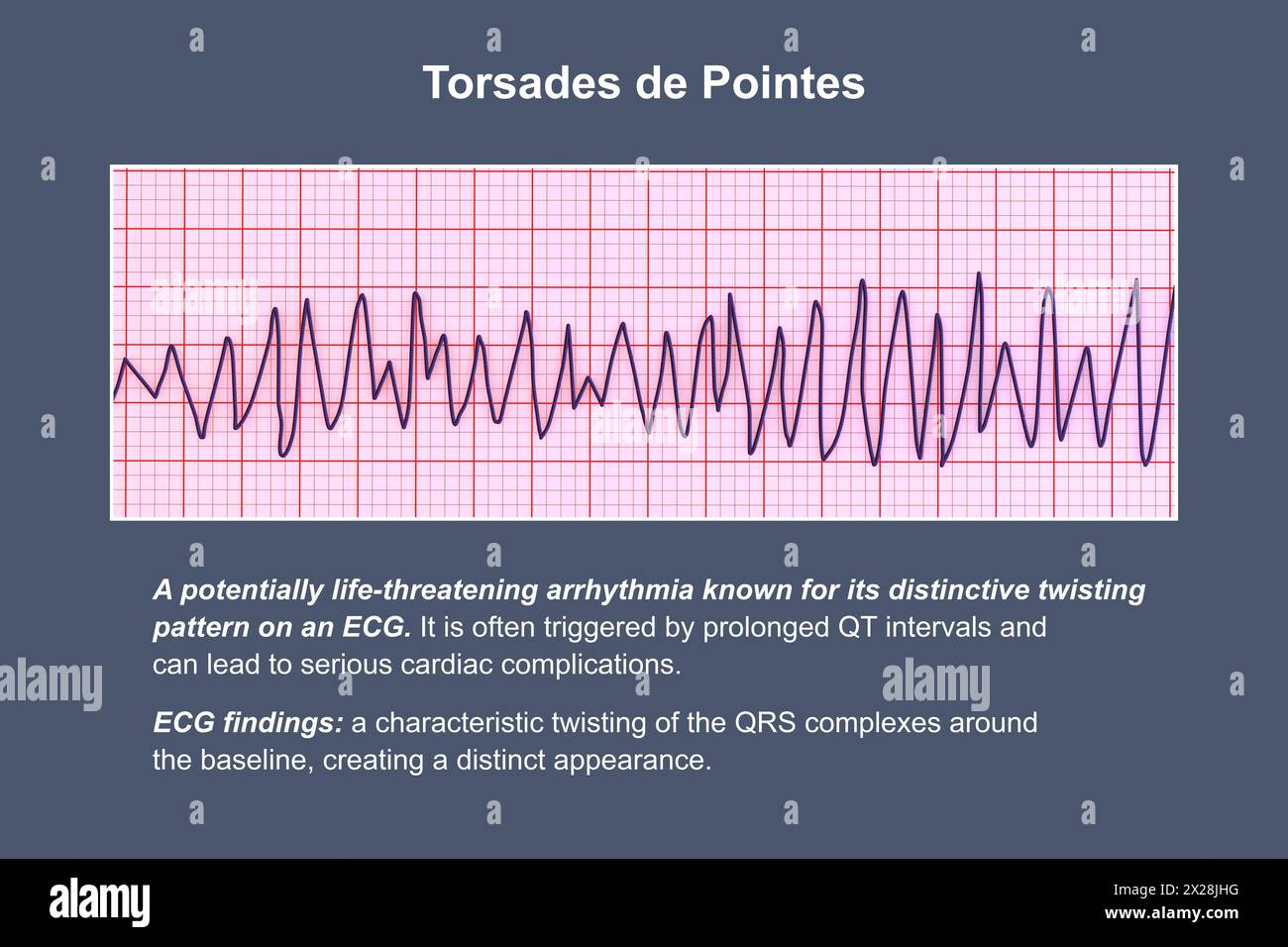 ECG displaying Torsades de pointes rhythm, illustration Stock Photo - Alamy