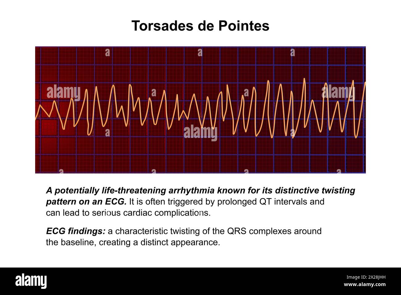 ECG displaying Torsades de pointes rhythm, illustration Stock Photo - Alamy