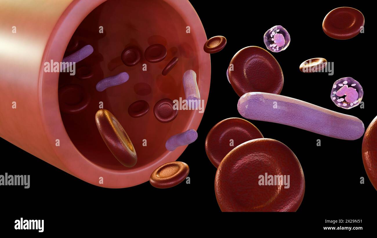 3d rendering of Septicemia, or sepsis, is the clinical name for blood ...