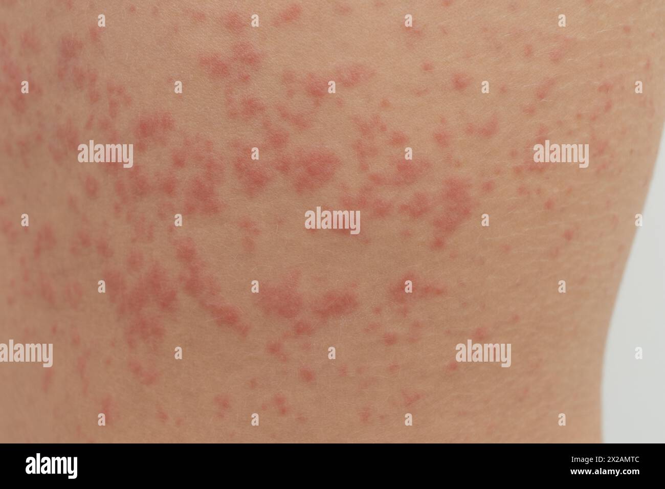 Acute allergy hi-res stock photography and images - Alamy