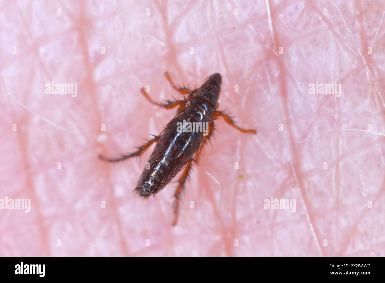 The flea feeds on human skin. Painful flea bite Stock Photo - Alamy