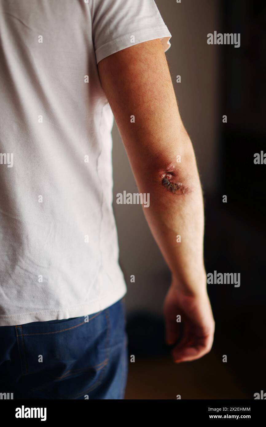 Burn skin scar hi-res stock photography and images - Alamy