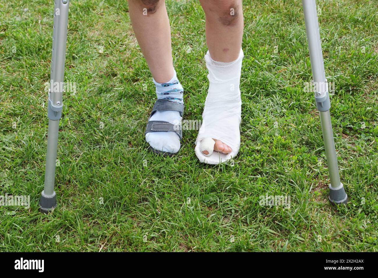 Legs of little boy on crutches; left leg in cast; boy stands on green ...