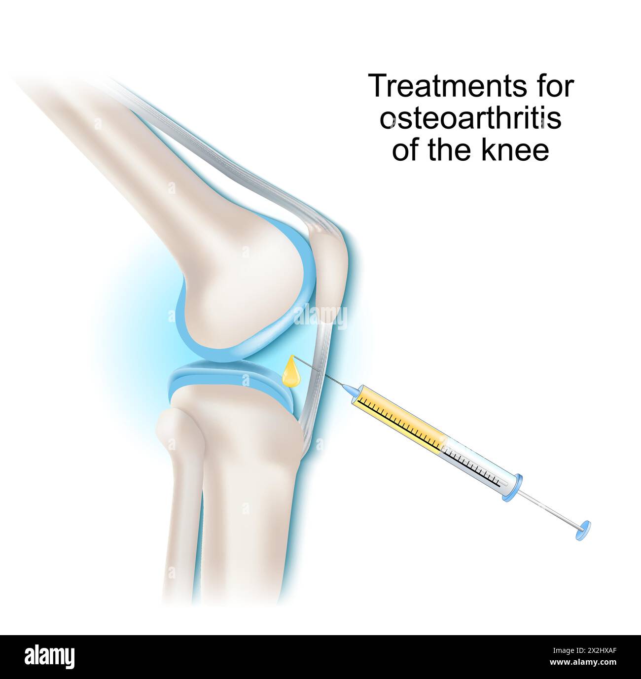 Joint degeneration of osteoarthritis Stock Vector Images - Alamy