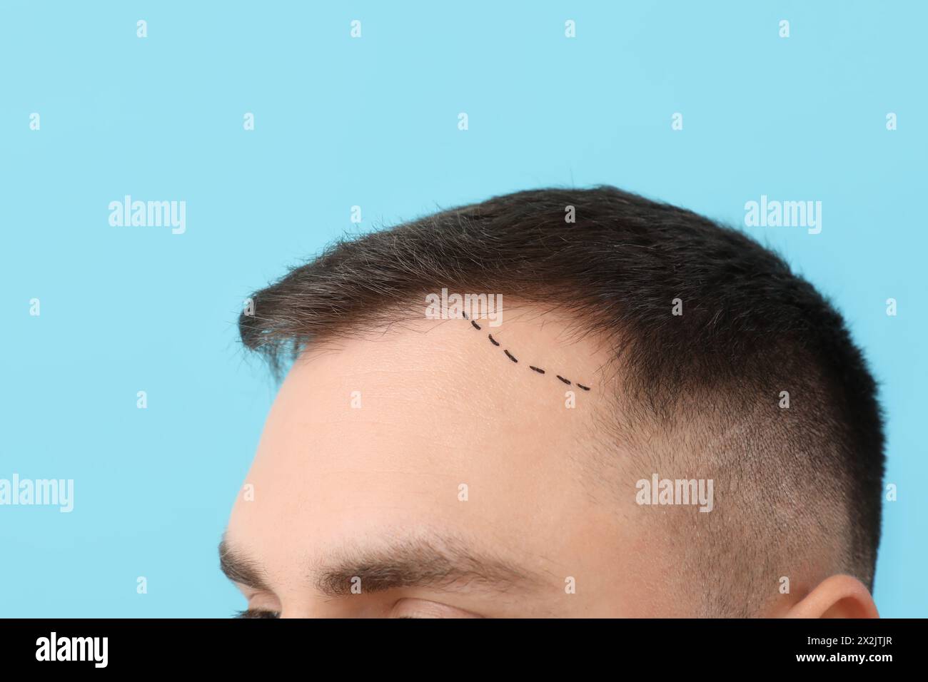 Young man with hair loss problem and marks on his forehead against blue ...