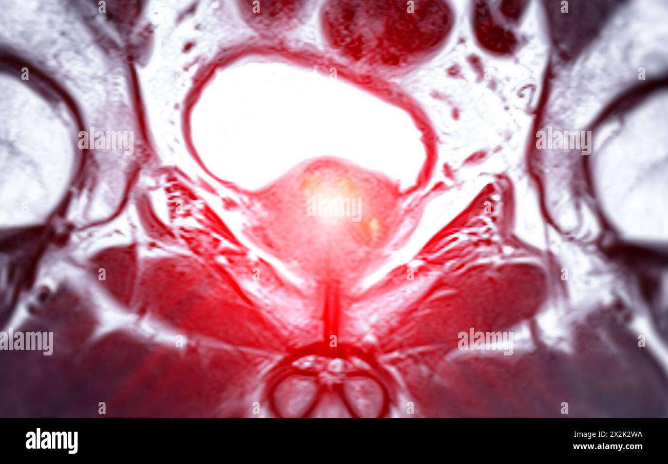 MRI of the prostate gland reveals Focal abnormal SI lesion at left PZpl ...
