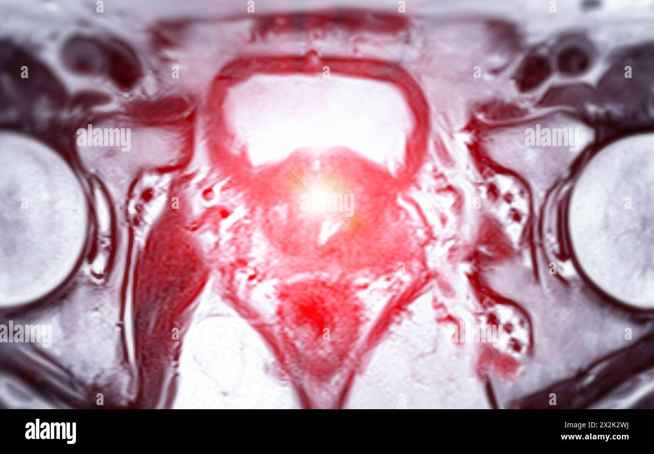 MRI of the prostate gland reveals Focal abnormal SI lesion at left PZpl ...