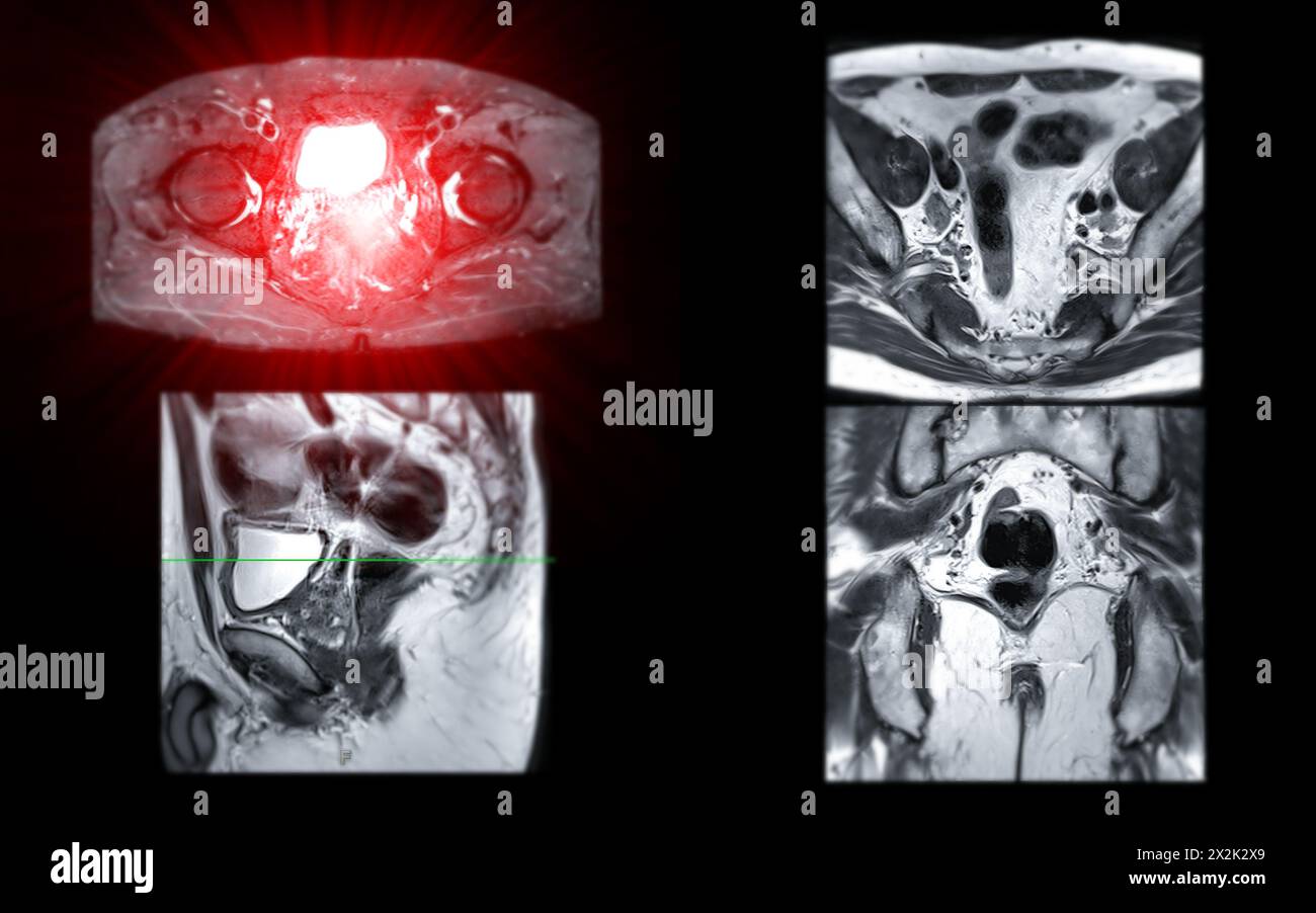 MRI of the prostate gland reveals Focal abnormal SI lesion at left PZpl ...